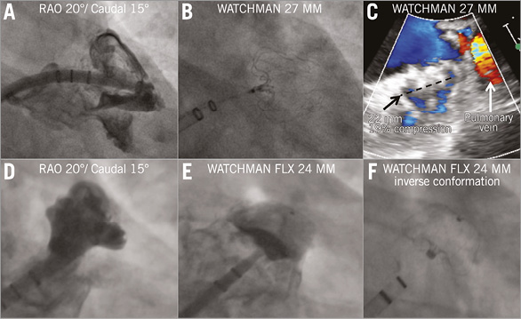 Left atrial appendage closure: patient, device and post-procedure drug ...