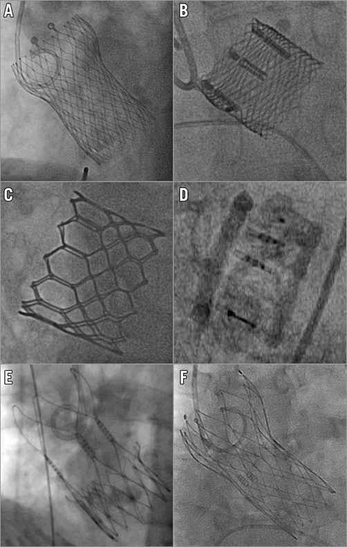 TAVI with current CE-marked devices: strategies for optimal sizing and ...