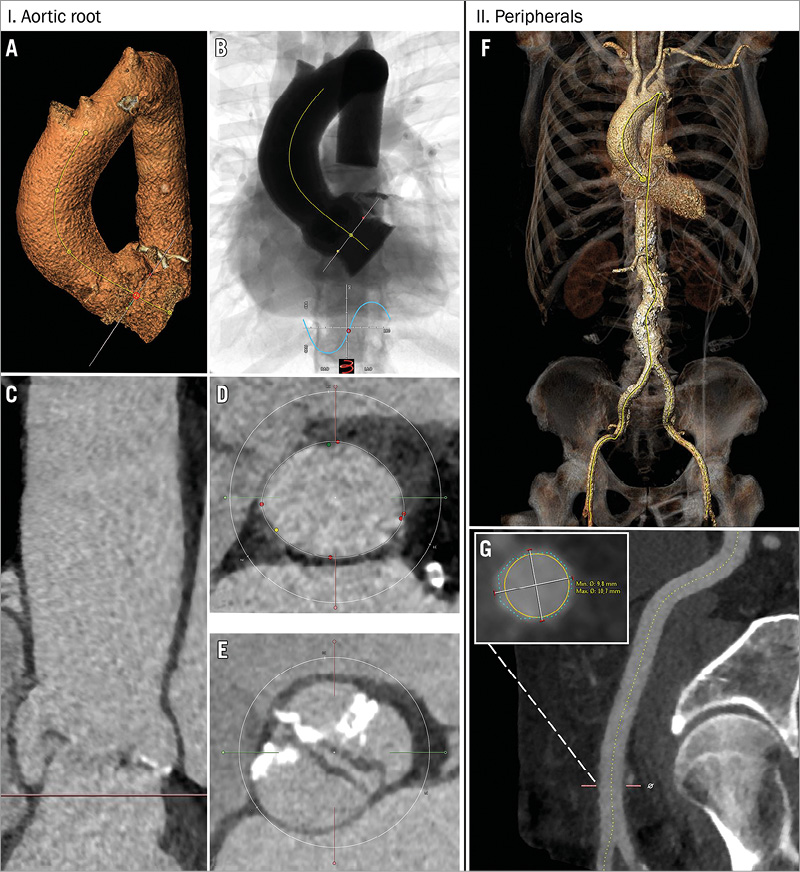 TAVI with current CE-marked devices: strategies for optimal sizing and ...