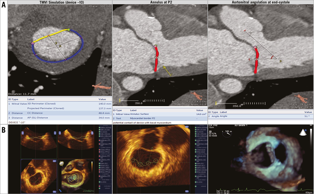 Transcatheter mitral valve implantation: Tendyne - EuroIntervention
