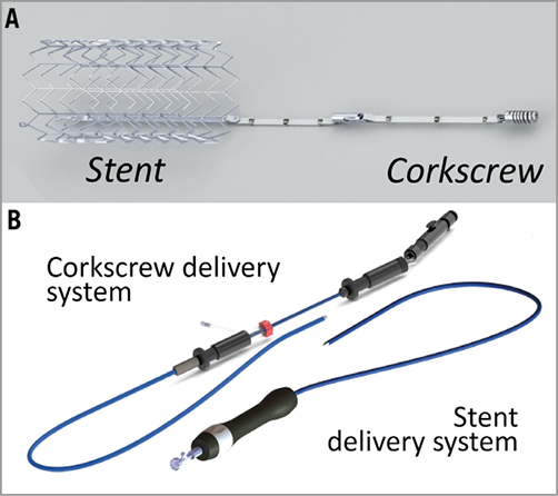 Transcatheter interventions for tricuspid regurgitation: TriCinch ...