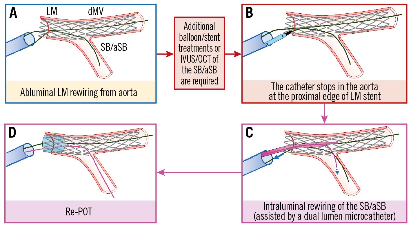 Treatment of coronary bifurcation lesions, part I: implanting the first stent in the provisional ...