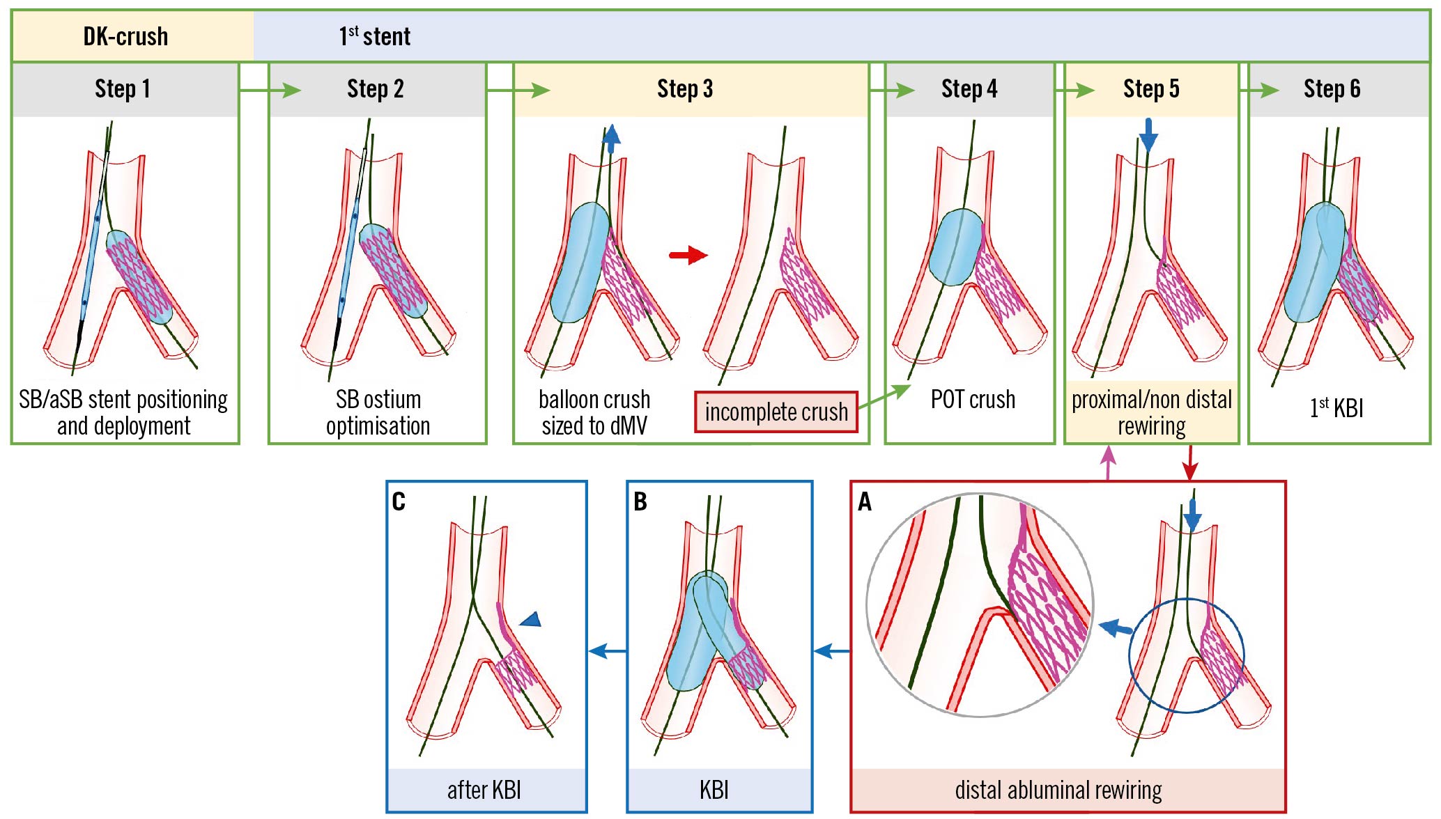 Treatment of coronary bifurcation lesions, part II: implanting two ...
