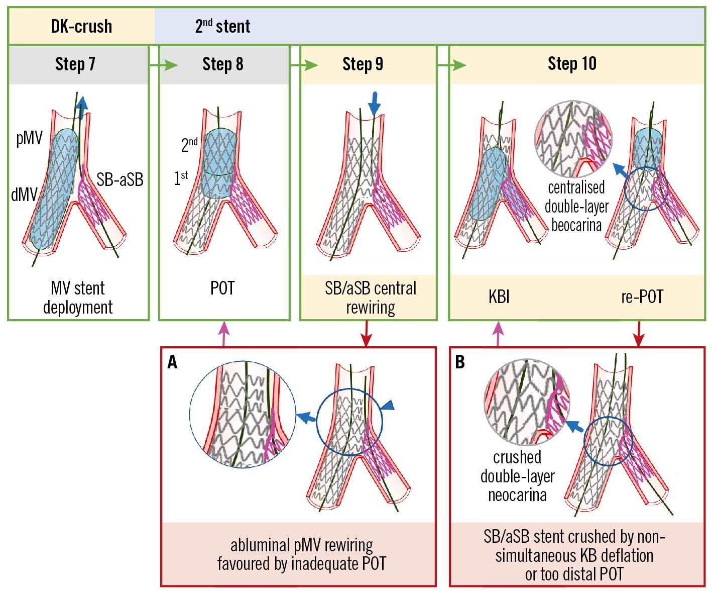 Treatment of coronary bifurcation lesions, part II: implanting two ...